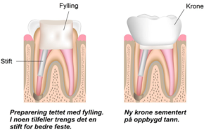 Rotfylling - Ibsen tannlegesenter